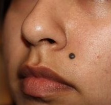Photos of Moles on Face and Neck ~ How To Remove Moles, Warts, Skin ...