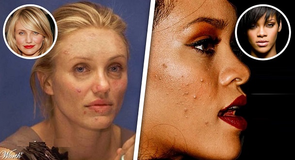 facepau: Conoce los 8 famosos con problema de ACNÉ que lo ocultan con ...