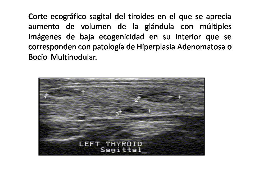 Exploraciones complementarias del tiroides