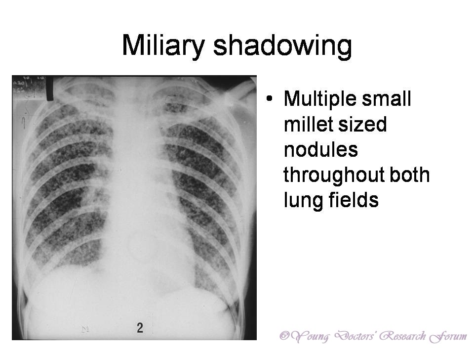 Identification of Chest X-rays of Common Lung Diseases ~ YOUNG DOCTORS ...