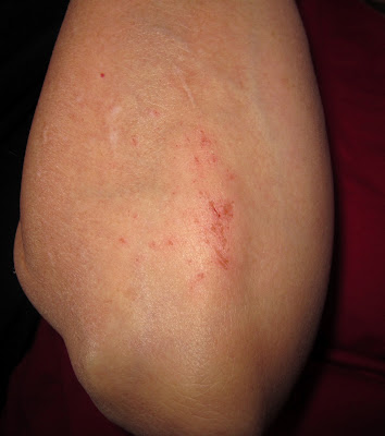 jm's Adventure with Multiple Myeloma: July 2012