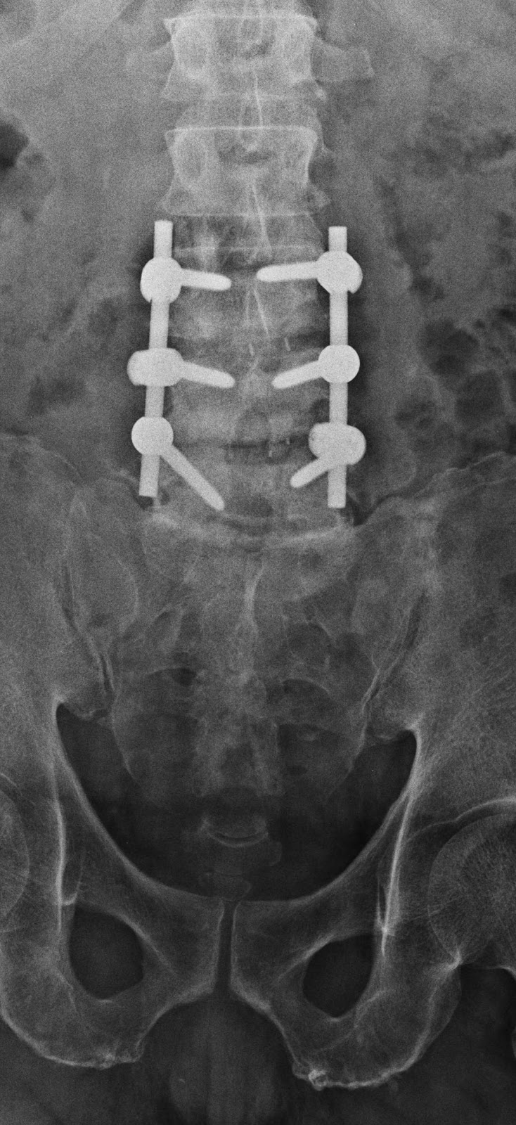 SPINE: Fixed in Abuja: Medical tourism for back pain