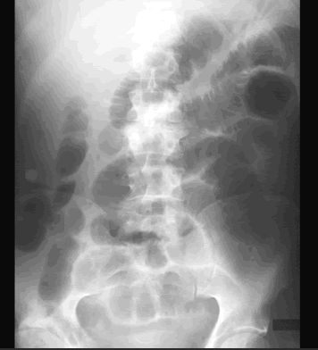 blog Rx,Tc e Rm....: APENDICITE AGUDA