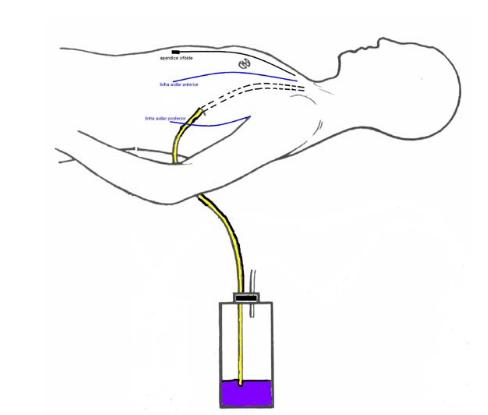 Cuidados de enfermagem ao paciente com dreno de tórax - Enfermagem ...