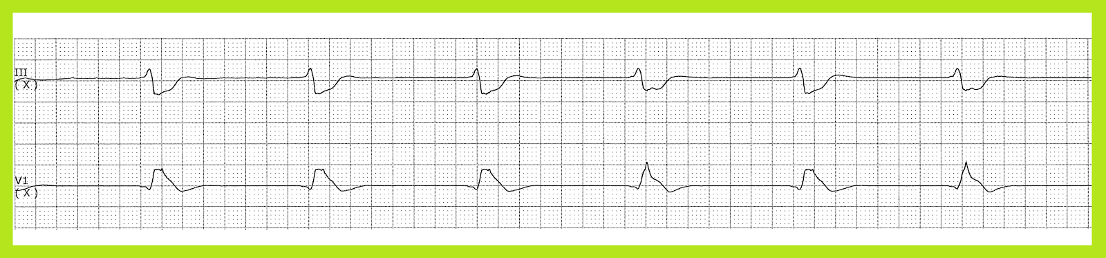 Various Idioventricular Rhythms