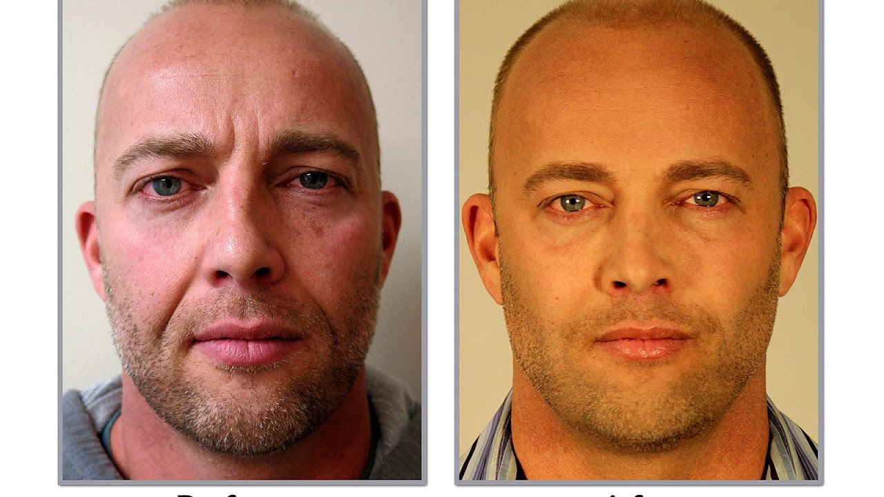 Non Invasive Face Lift Options - Lift Choices