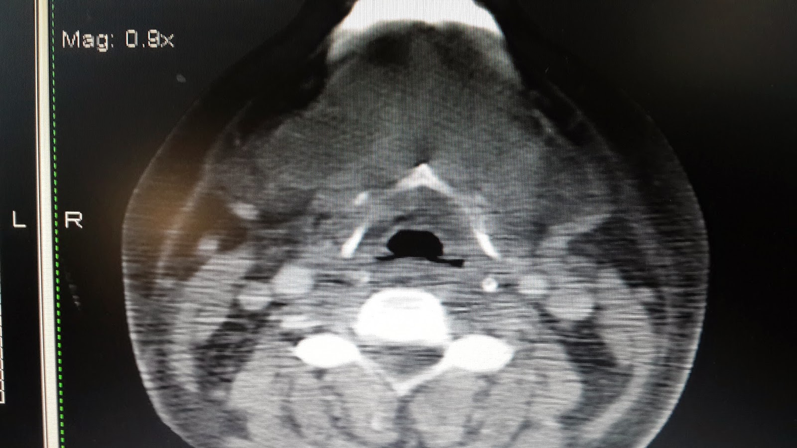 tajea journal of medicine: El rincón de la Medicina Interna. ANGINA DE ...