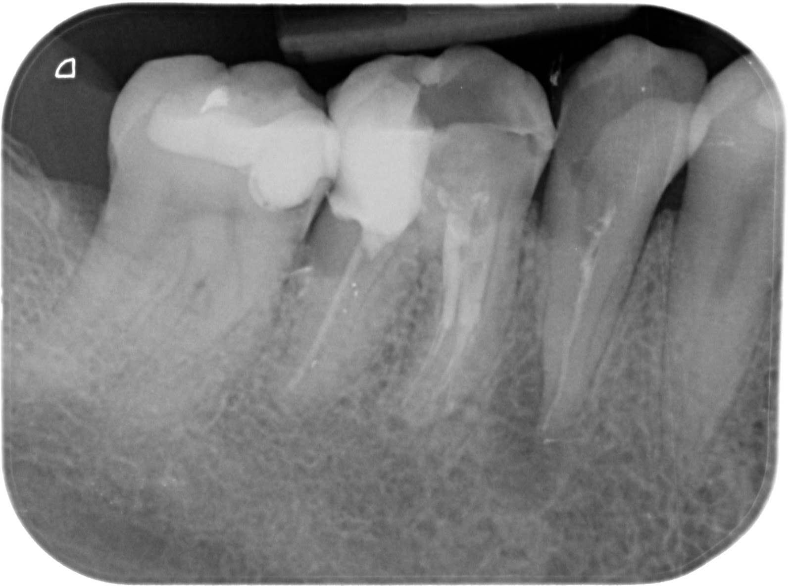 Caso Clínico Master: Retratamiento Multicolor