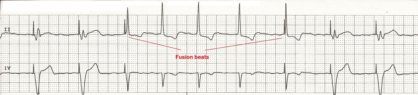 EKG Rhythm Strips 73