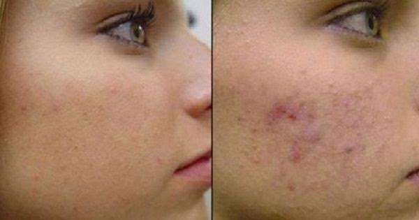 How to Get Rid Of Redness From Acne And Pimples