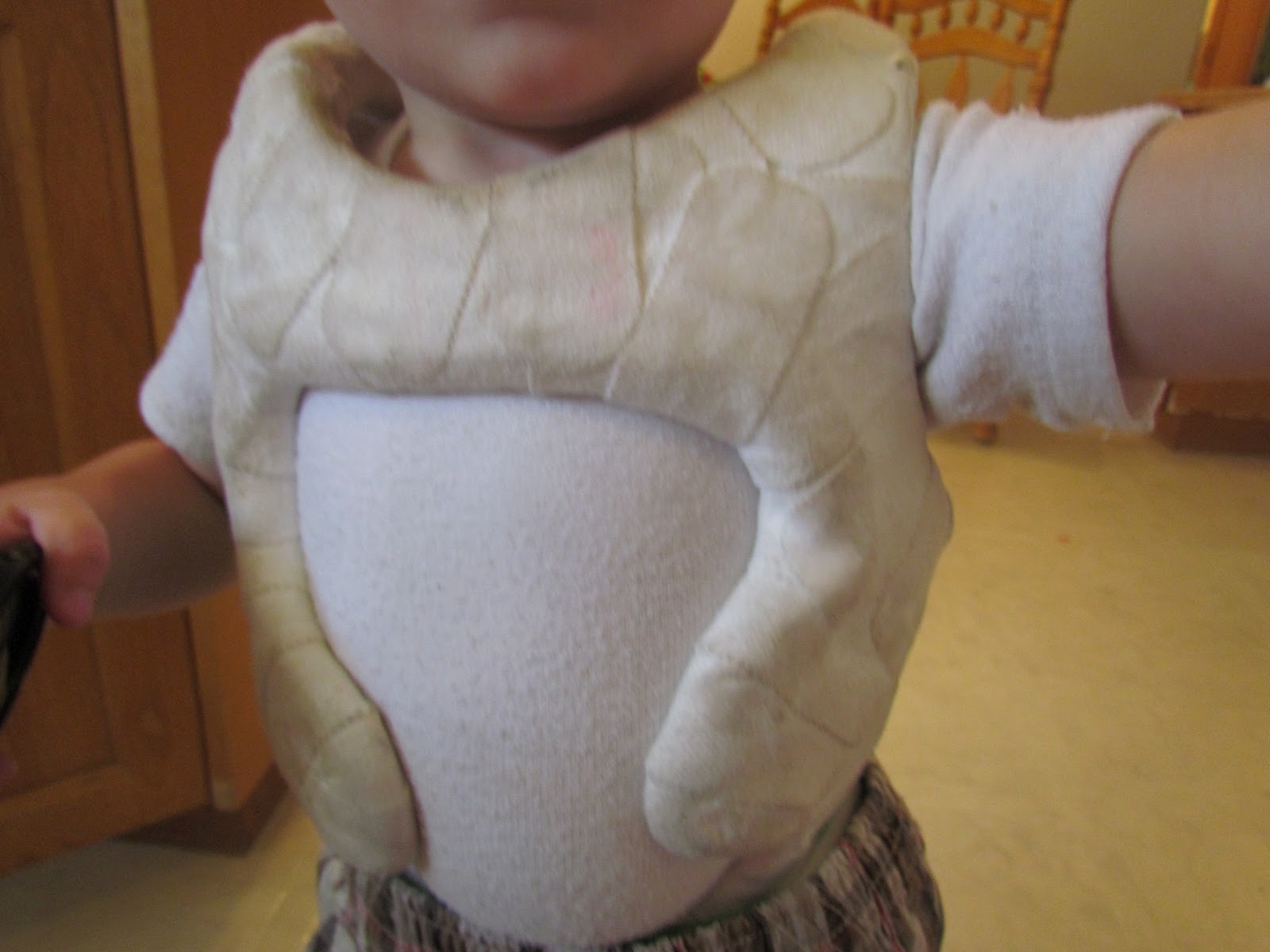 Our Journey through Progressive Infantile Scoliosis: Cast pictures!!