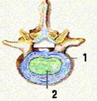 Medicina y Fisioterapia: Degeneración del disco intervertebral/ Hernias ...