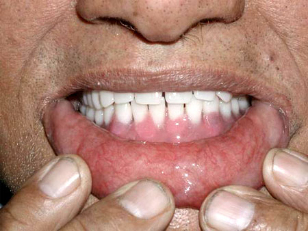 Front Flipper Dental