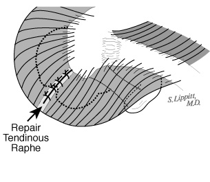 UW Shoulder and Elbow Academy: Rotator Cuff 11 - Surgery for rotator ...