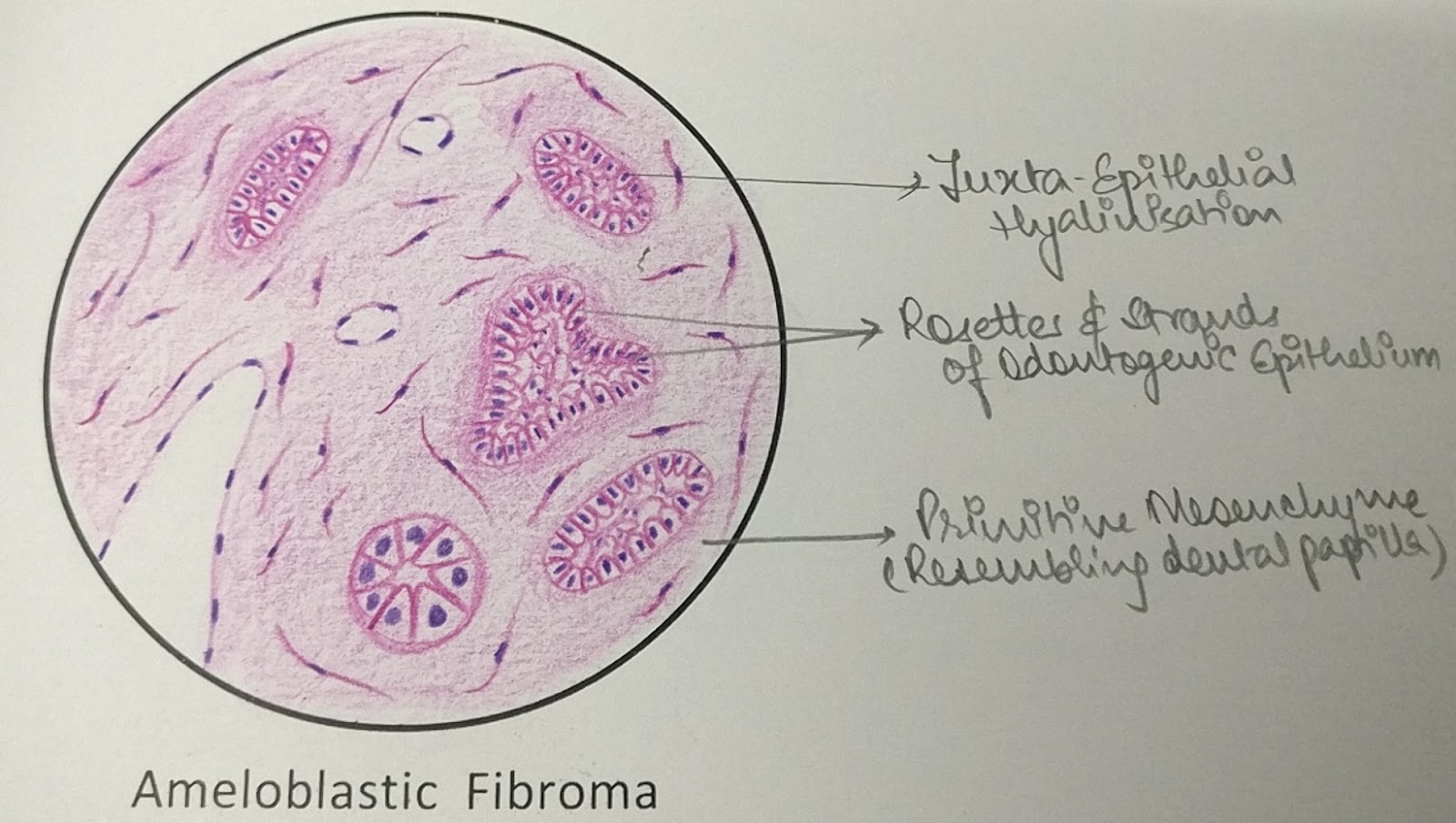 Ameloblastic Fibroma Histology