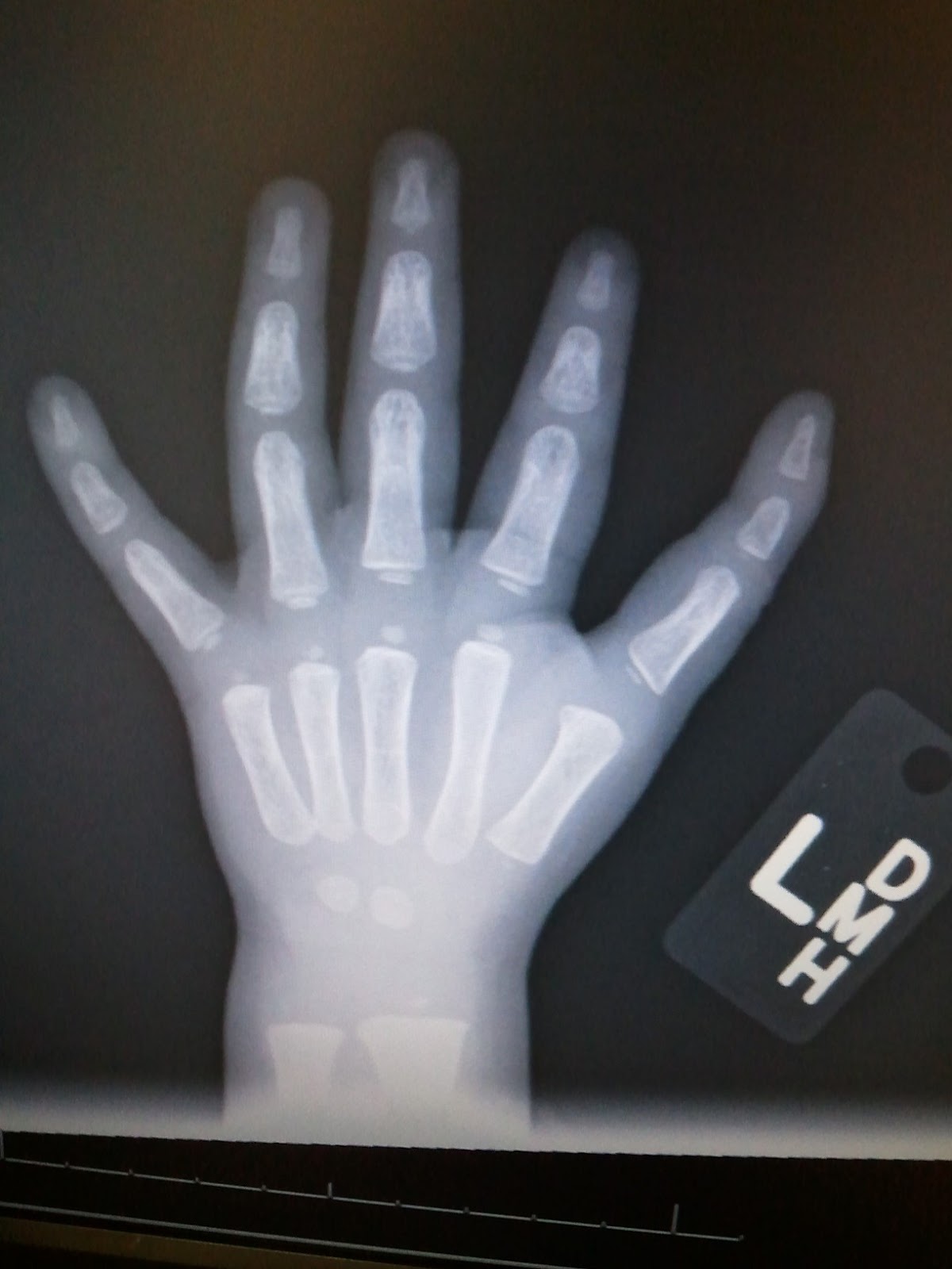 finding joy.: Update | Triphalangeal Thumbs