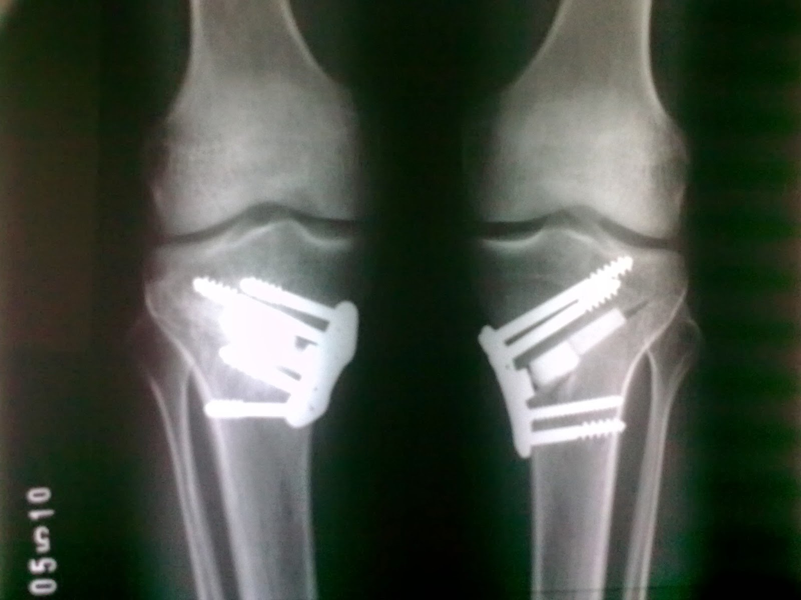 Fernando Conceição: Cirurgia de osteotomia valgizante (pernas arqueadas)