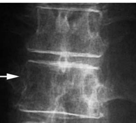 Vertebral pedicle involvement in skeletal metastasis: Plain Radiograph ...