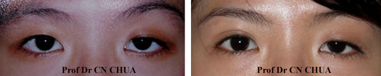 Eyelid Surgery by Prof Dr CN CHUA 蔡鐘能: Unequal Double Eyelids (skin ...