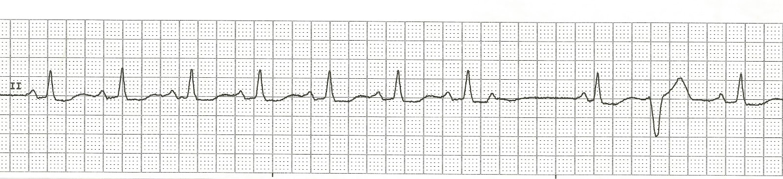 ECG Rhythm Strip Quiz 112