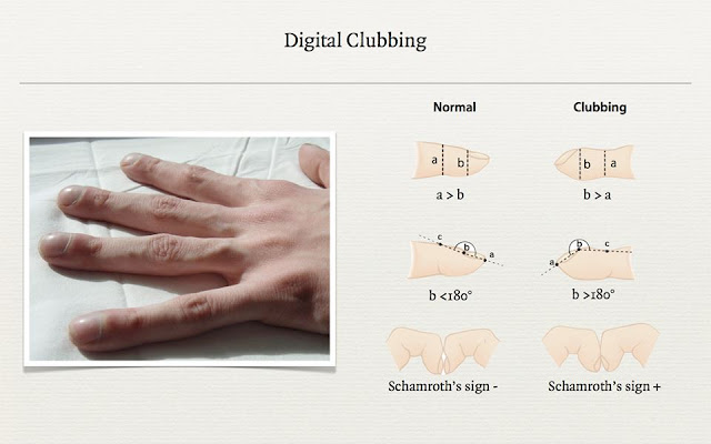 Naut's Medical Tips: Clubbing of Fingers