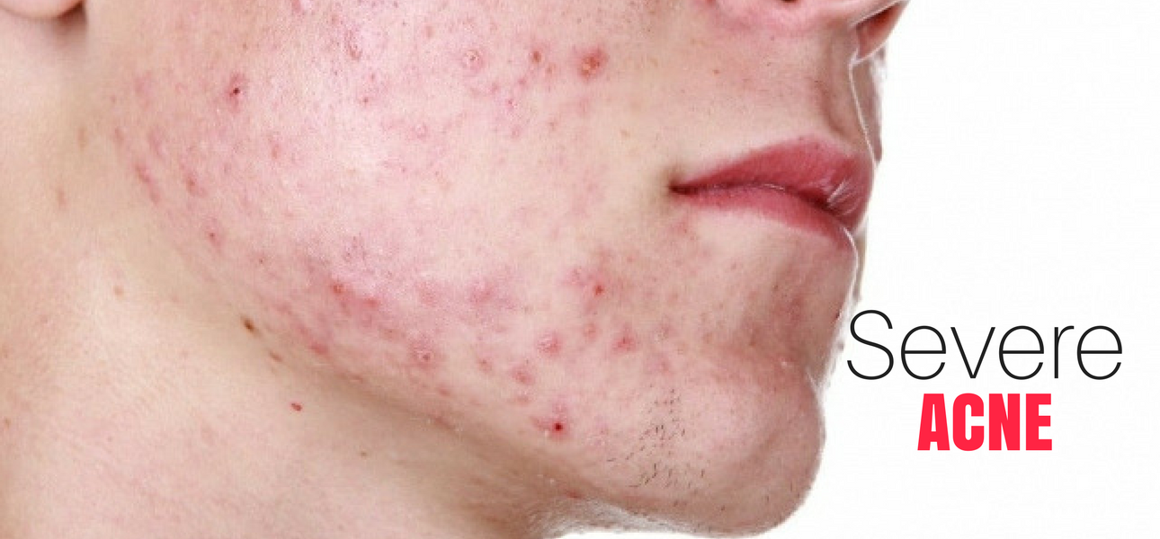 How to Deal with Different Type of Acne? - Skin Care Blog - Clinica ...