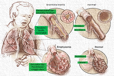 Dunia Mahesarani: Kenali Paru-paru Anda dan Berbagai Penyakitnya