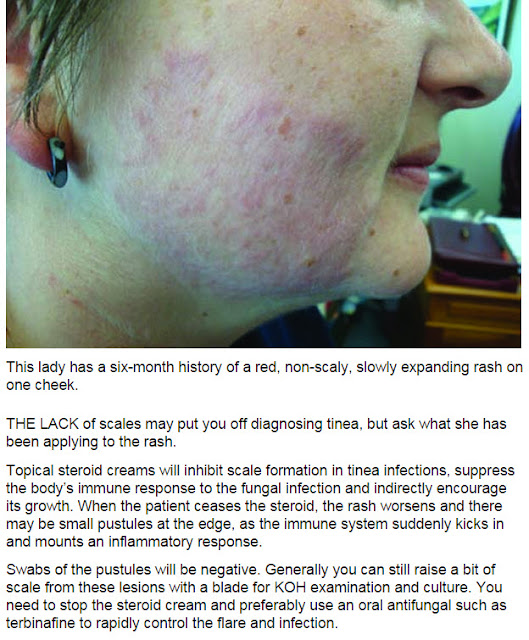Consultations in Dermatology: Tinea incognito