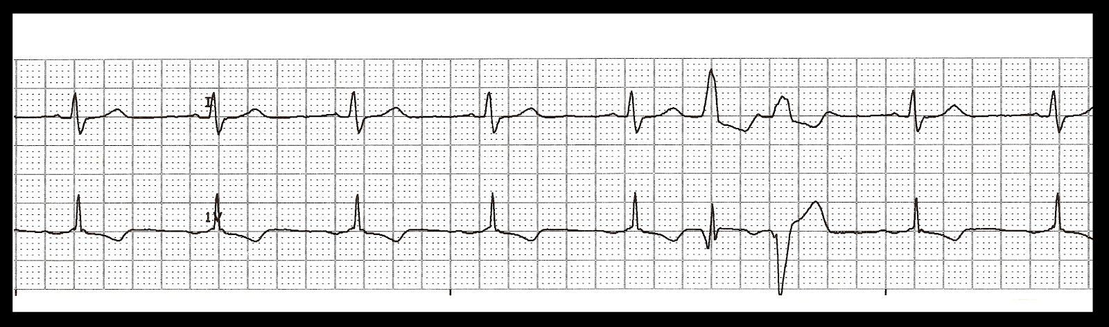 EKG Rhythm Quiz 230