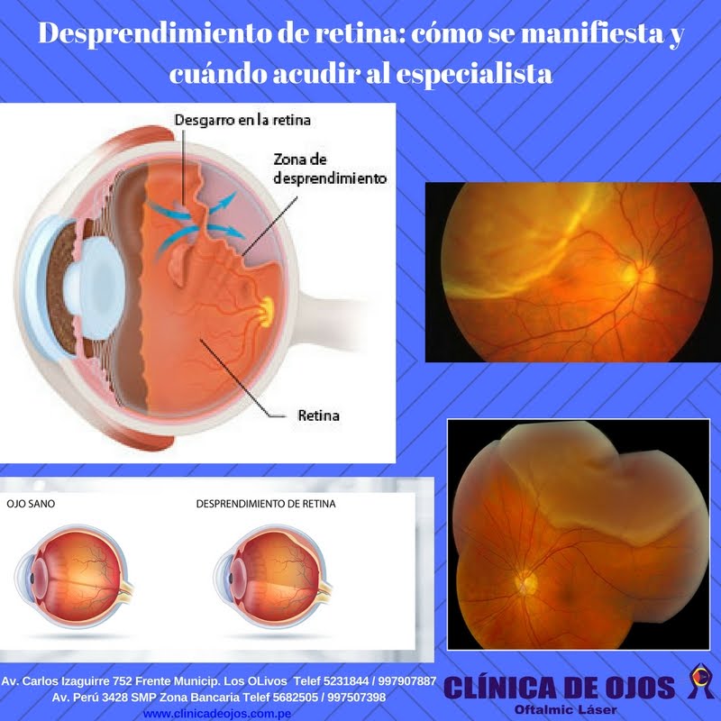Clínica de Ojos Oftalmic Láser: Desprendimiento de retina: cómo se ...