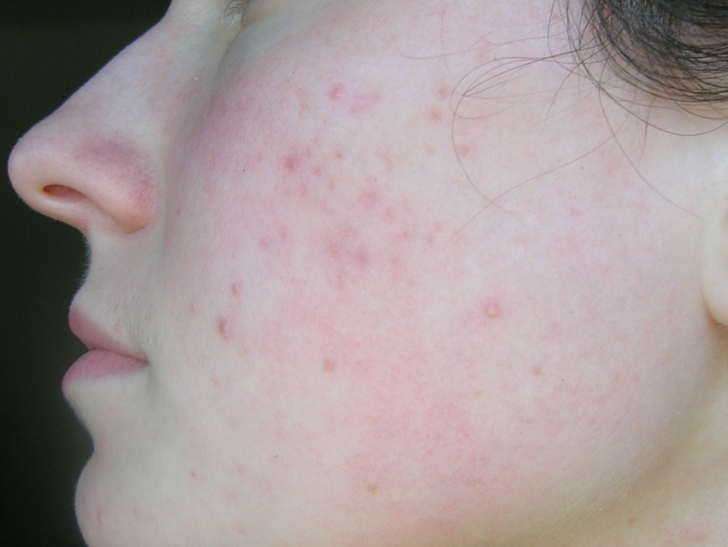 Superficial Shortcomings: Acne Scar Journey