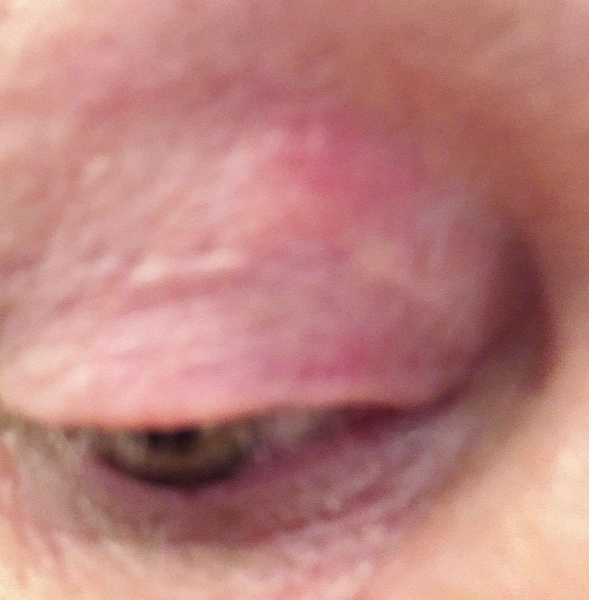 The Juicy Beauty Word Eyelid Dermatitis Red Flaky Eyelids the-juicy-beauty-word-eyelid-dermatitis-red-flaky-eyelids