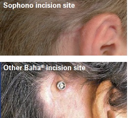 El OtoBlog: El Sophono Alpha 1 (M)