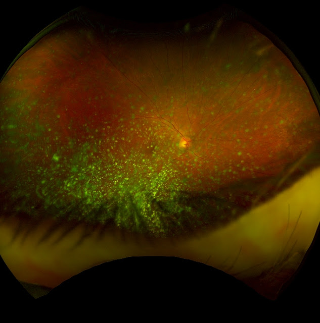 Sonoran Desert Eye Center: ASTEROID HYALOSIS