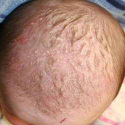 Cara Mengobati Dermatitis Seboroik Secara Alami | Gudang Obat Penyakit ...