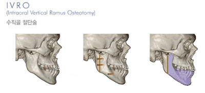악교정수술 양악수술 하악수술 IVRO ~ Healthy Happy
