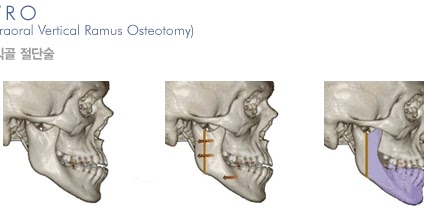 악교정수술 양악수술 하악수술 IVRO ~ Healthy Happy