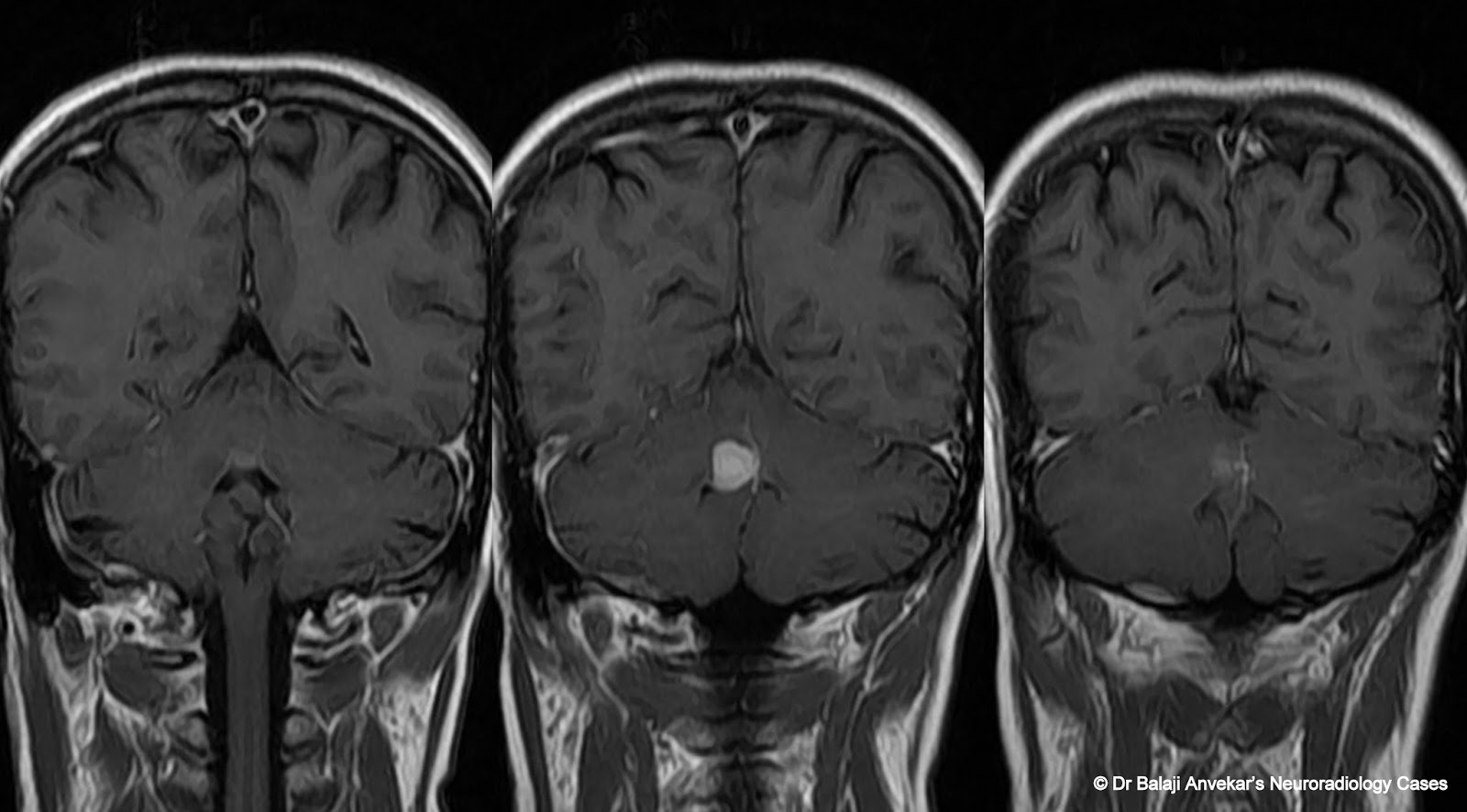 Dr Balaji Anvekar FRCR: A focal Vermian bleed on MRI