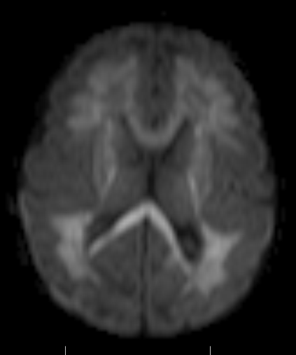 Periventricular leukomalacia -MRI - Sumer's Radiology Blog