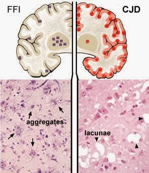 퇴행성 뇌질환 - 2. CJD(Creutzfeldt-Jakob Disease)’s Diagnosis | Brain Interactive