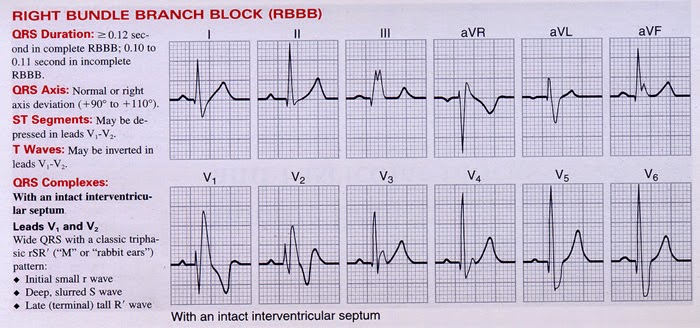 Right Bundle Branch Block / RBBB (Blok Cabang Berkas Kanan) - MUZARRO