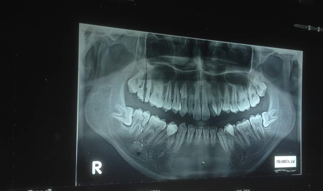 Pengalaman Operasi Gigi Geraham Bungsu (Operasi Odontectomy) - Monyoku