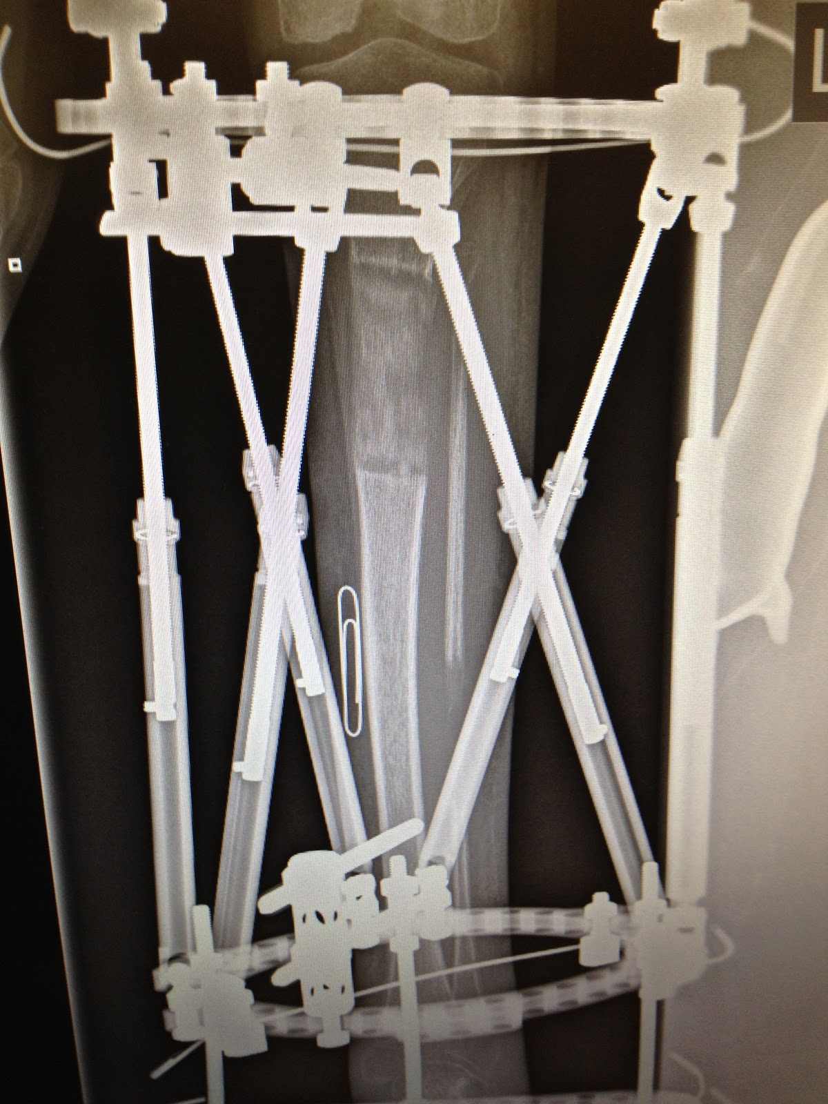 fibular hemimelia leg lengthening: 5.6 and growing: Final Plan for ...