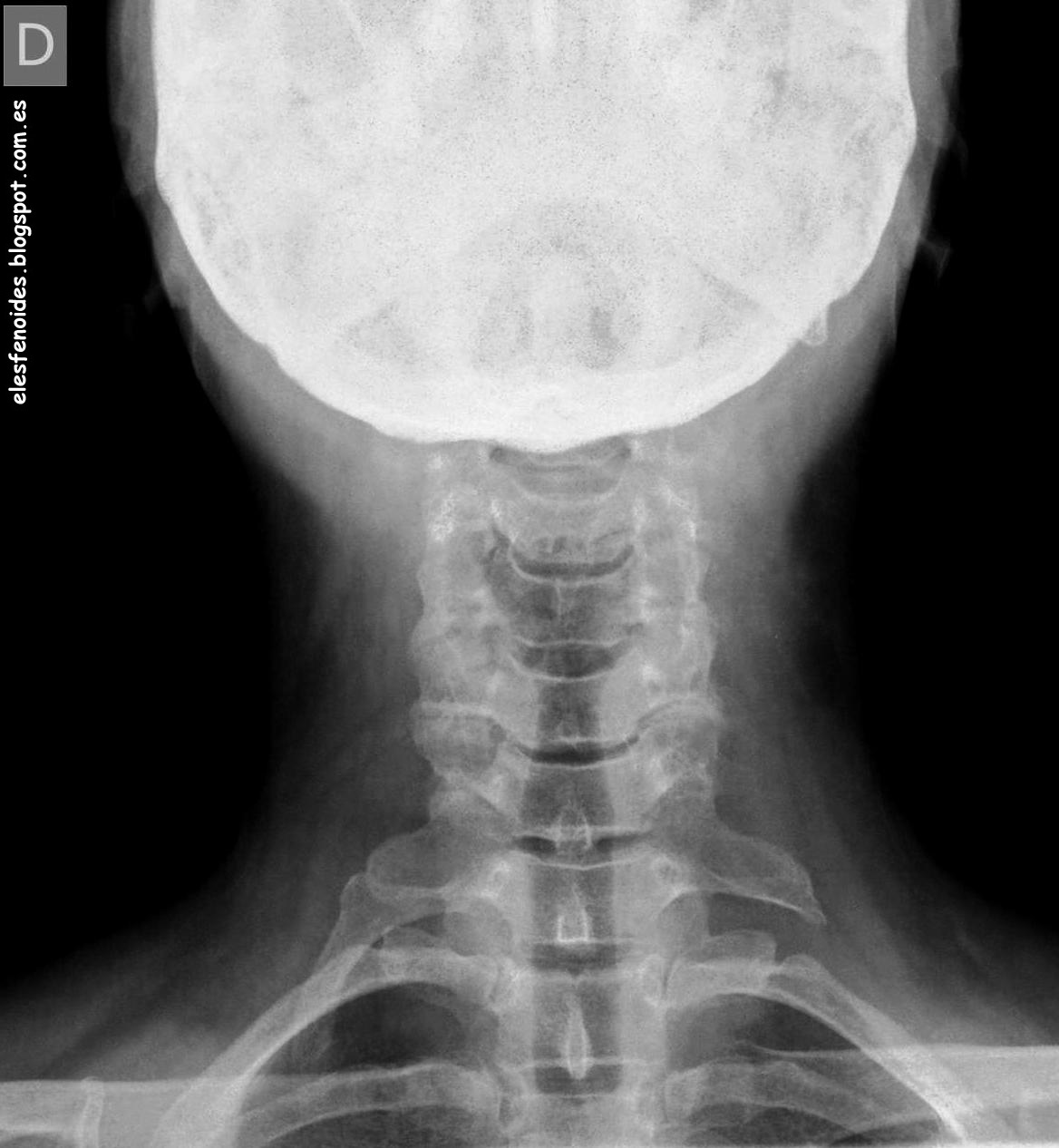 El esfenoides: Costilla cervical. 2 imágenes 1 caso.