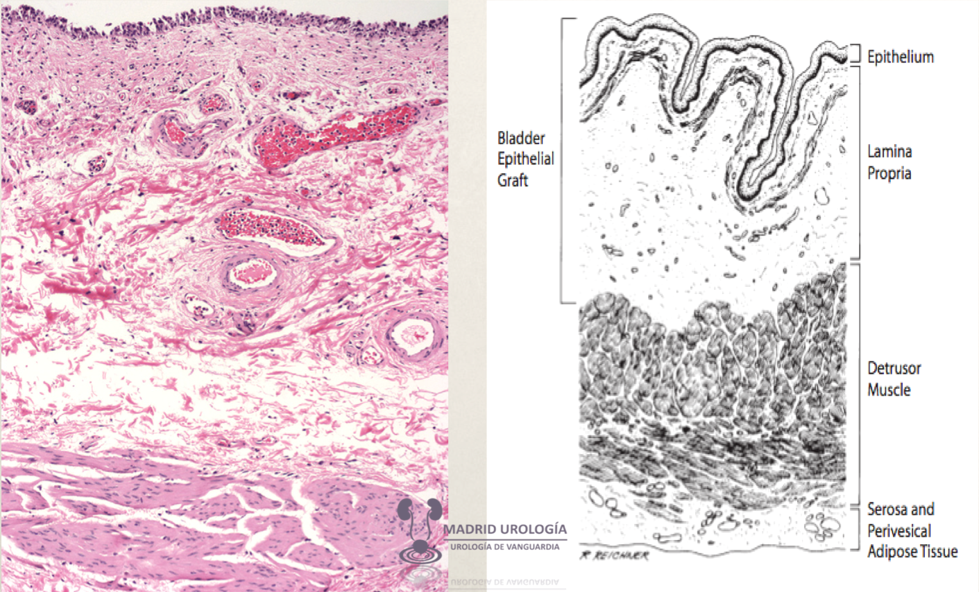 Madrid Urología: Cáncer de Vejiga. Histología 2. MU. Capítulo 2. Sección 2