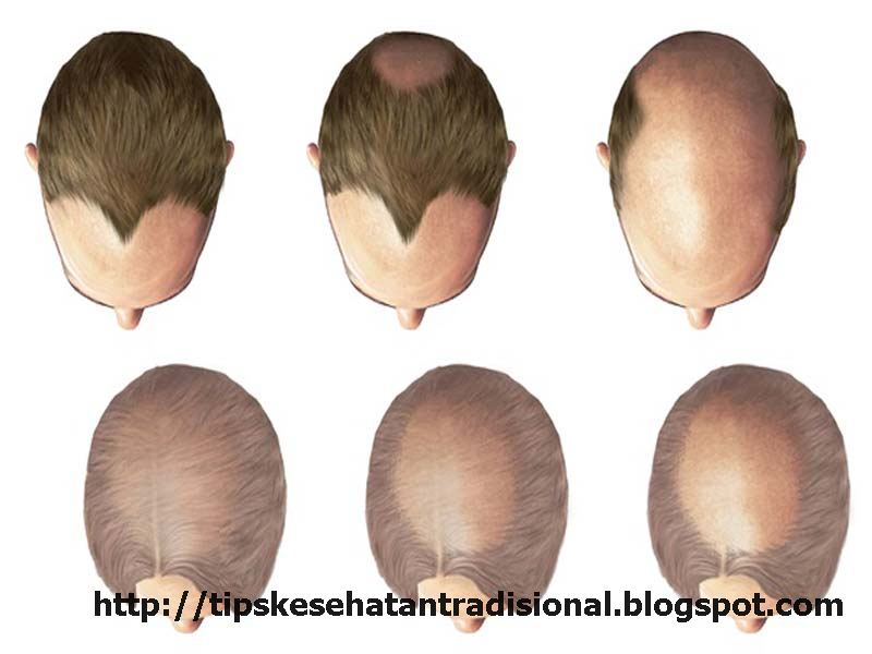 Jenis rambut rontok yang di sebabkan oleh faktor genetik atau keturunan ...
