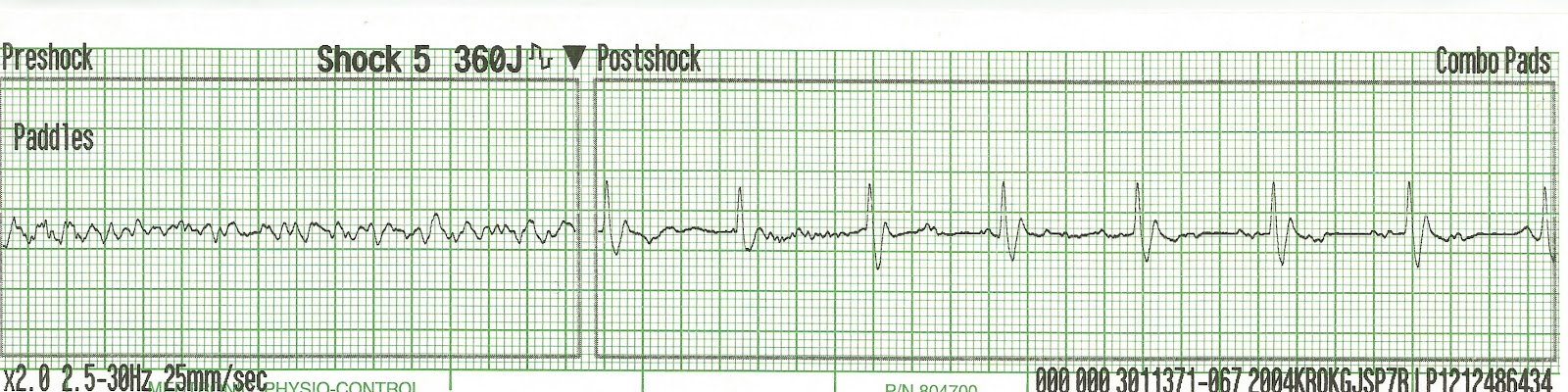 Code Blue: Refractory Ventricular Fibrillation