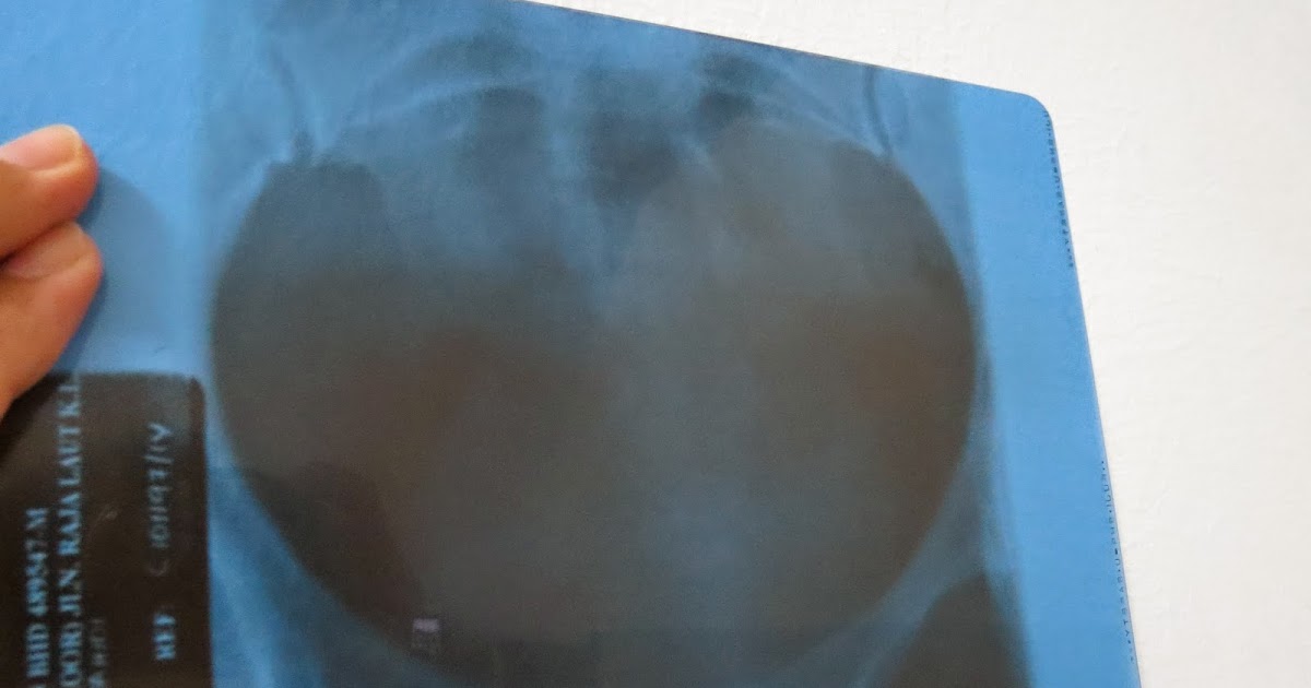 warna warni hidupku..............: TTC Journey 03: HSG scan