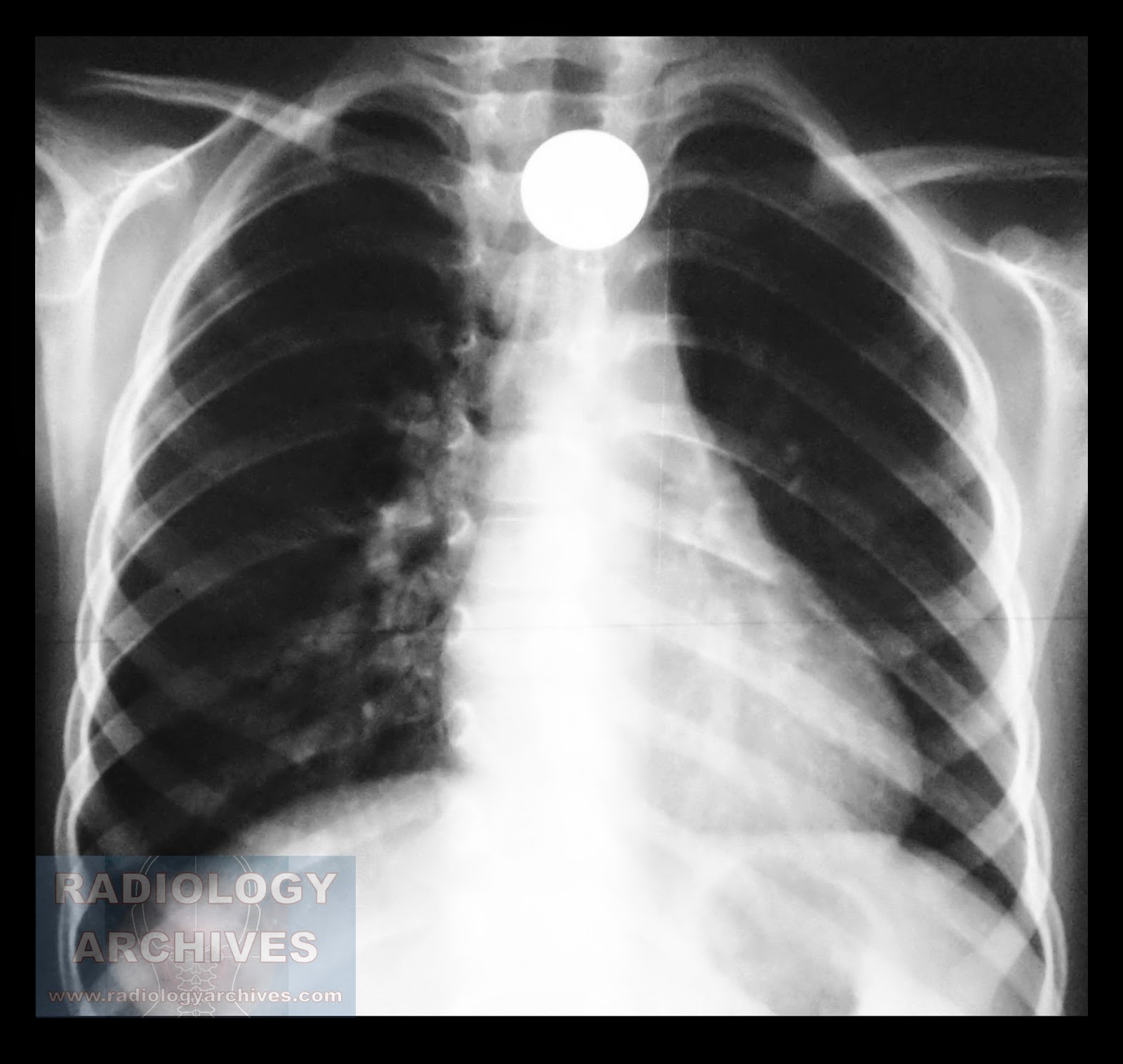 Radiology Archives: Ξένο Σώμα (Νόμισμα) στον Οισοφάγο