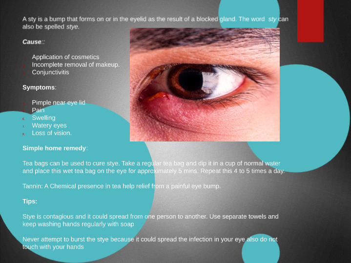 Health Tips: Home remedies to cure eye infection - Stye or Eye Bump